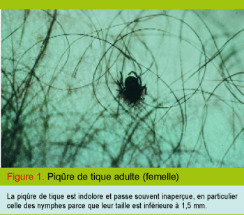 La borréliose de Lyme : de l'érythème migrant à l'arthrite de Lyme ...