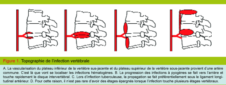Spondylodiscite infectieuse : le regard du rhumatologue - Revue ...