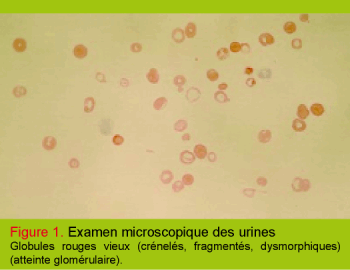 Hématurie et protéinurie chez l'enfant : attitude pratique - Revue ...