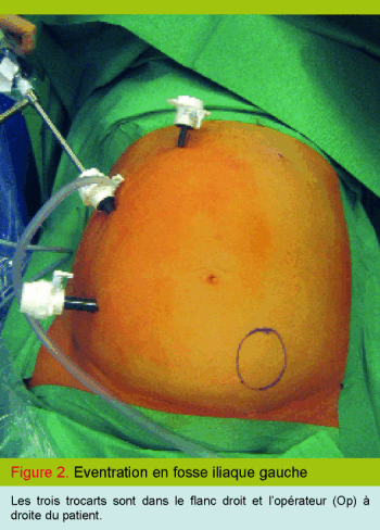 Cures d'éventration et des hernies ombilicales volumineuses par ...