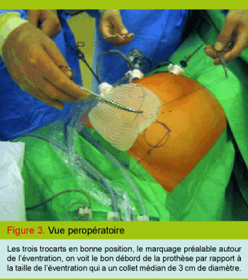 Cures d'éventration et des hernies ombilicales volumineuses par ...
