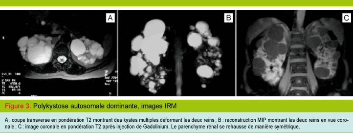 Quelle attitude lors de la découverte de kystes rénaux ? - Revue ...