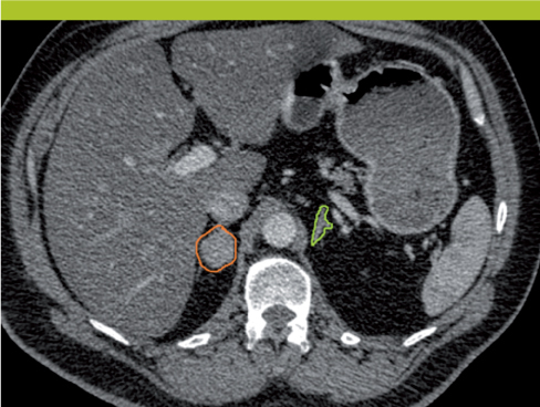 Hyperaldostéronisme primaire sur adénome ou hyperplasie de la surrénale ...