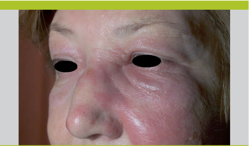 Erysipèle : manifestations cliniques et prise en charge - Revue ...