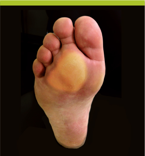 Métatarsalgies : diagnostic et prise en charge - Revue Médicale Suisse