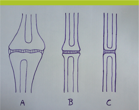 Pseudarthroses aseptiques des os longs - Revue Médicale Suisse