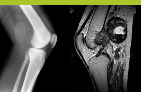 Kystes poplités: approches étiologique et thérapeutique - Revue ...