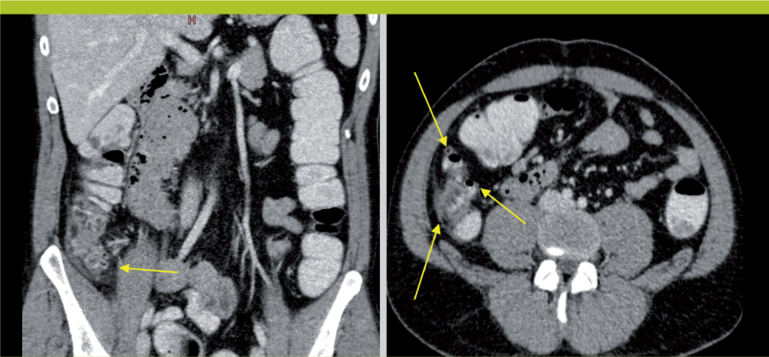 Maladie diverticulaire du côlon droit : quo vadis ? - Revue Médicale Suisse