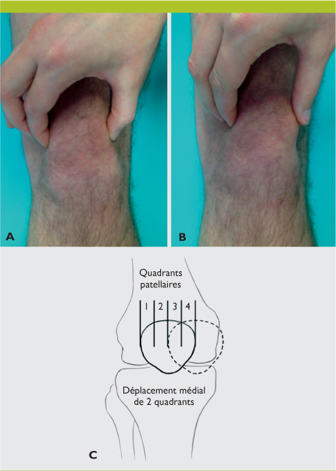 Mieux comprendre le syndrome douloureux fémoro-patellaire… pour mieux ...