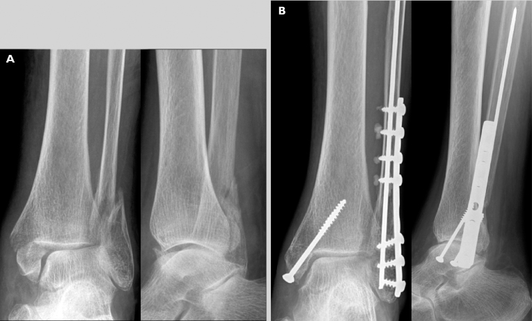 Fractures de la cheville chez le patient âgé - Revue Médicale Suisse