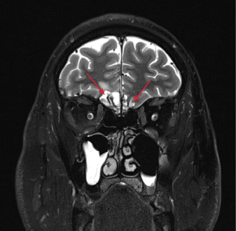 Anosmie et agueusie : à propos d’un cas - Revue Médicale Suisse