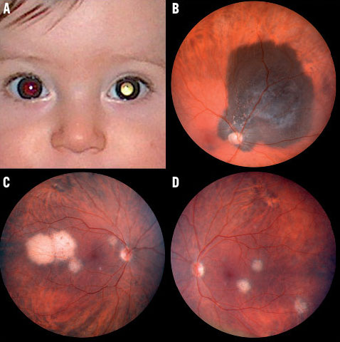 Œil et cancer - Revue Médicale Suisse