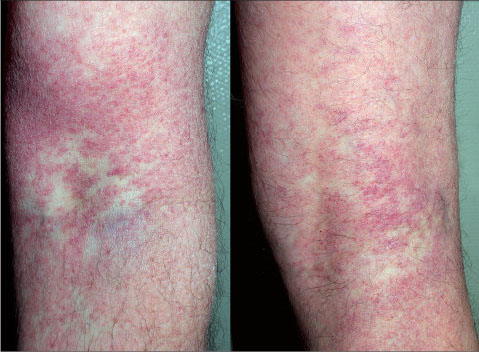 Syndrome DRESS (drug reaction with eosinophilia and systemic symptoms ...