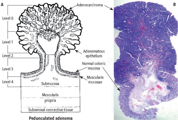 Epidémiologie, prise en charge et suivi des polypes colorectaux - Revue ...