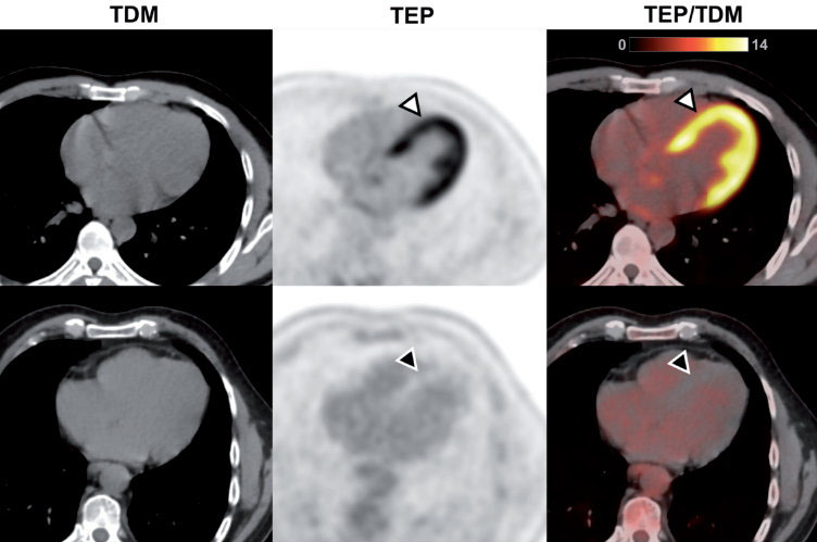 Sarcoïdose cardiaque : sept points à rappeler pour ne pas manquer le ...