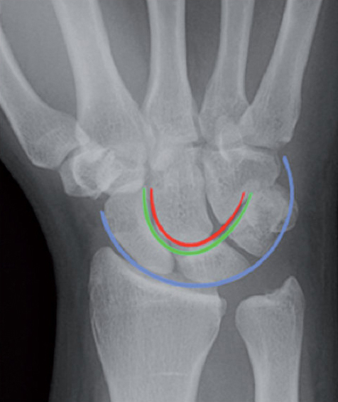 cal osseux metatarse