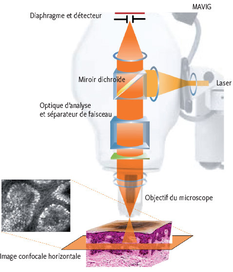 Microscopie confocale in vivo : quel avenir en dermatologie ? - Revue ...