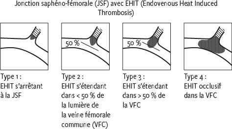Prise en charge interventionnelle de l’insuffisance veineuse ...