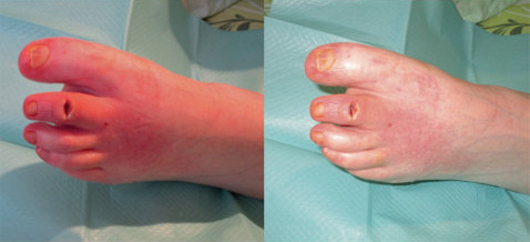 Infection de plaies chroniques : particularités chez la personne âgée ...