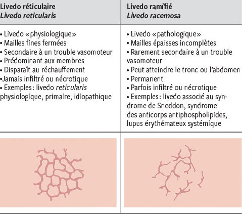 Le livedo : physiopathologie et diagnostic - Revue Médicale Suisse