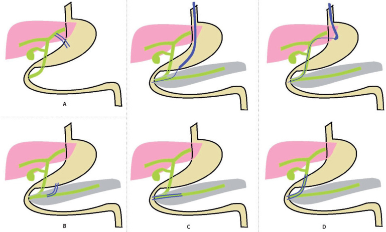 Drainage des voies biliaires et du pancréas par échographie ...