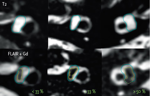 Maladie de Menière, hydrops endolymphatique et IRM - Revue Médicale Suisse