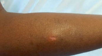 Staphylocoques dorés producteurs de leucocidine de Panton-Valentine ...